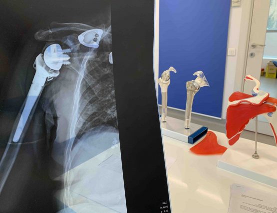 Artroscopia umărului. Repararea rupturii de coafa rotatorilor. Dr. Popescu